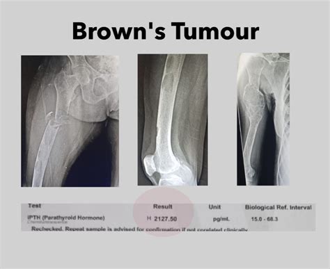 Copy Of Bone Tumour Mimics