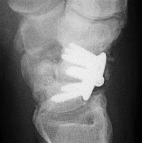 Four Corner Arthrodesis Using A Circular Plate And Distal Radius Bone Grafting A Consecutive