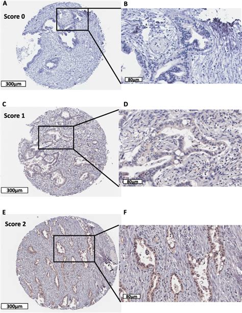 Ror1 And Ror2 Expression In Pancreatic Cancer Pmc