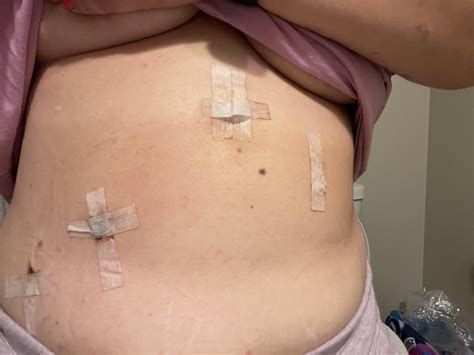 Incisional Hernia Rhernia