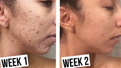 How To Clear Acne In 2 Weeks Makari De Suisse Skincare