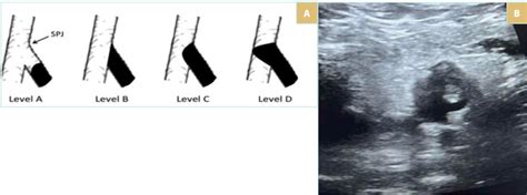 Pathogenesis Diagnosis And Treatment Of Endothermal Heat Induced