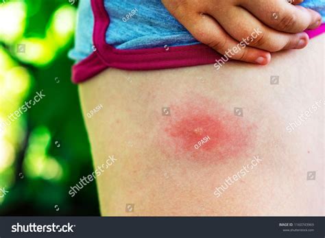 334 Imagens De Tick Bite Rashes Imagens Fotos Stock E Vetores Shutterstock