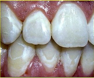 Enamel Decalcification