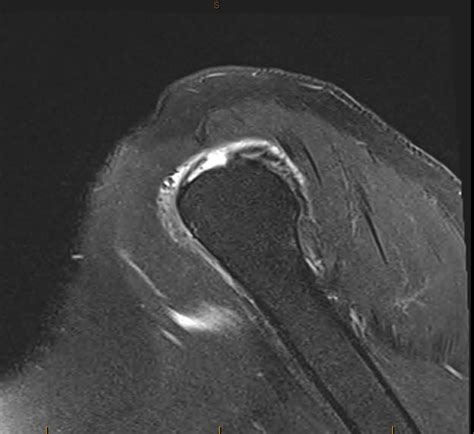 Rotator Cuff Tears Dr Doron Sher