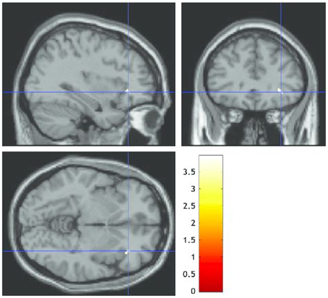 multiple regression analysis using voxel based morphometry to identify