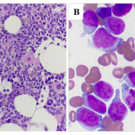 Bone Marrow Morphology In A Representative Case Case 8 A Bone Download Scientific Diagram
