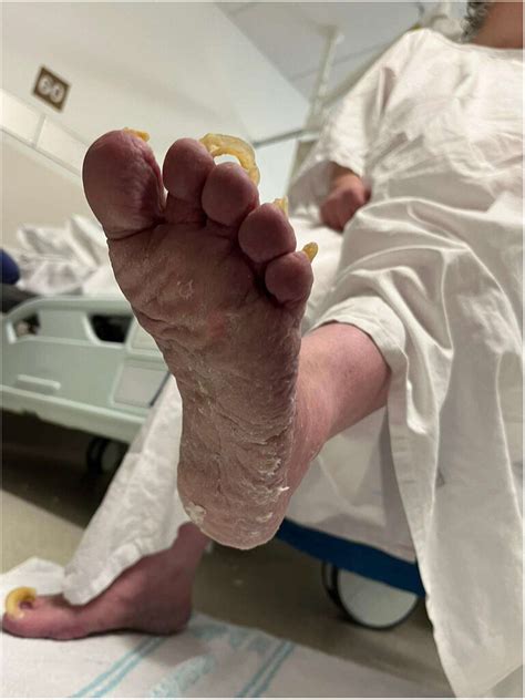 Severe Palmoplantar Keratoderma A Cutaneous Complication From Sub Optimally Controlled Type 2