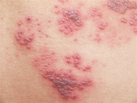 Mayo Clinic Q And A Vaccine Recommended For Older Adults Even If They
