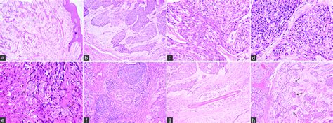 Polymorphous Growth Pattern With Tumor Cells Arranged In Characteristic Download Scientific
