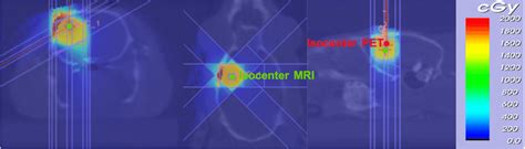 Representation Of Rt Treatment Plan Using Six Non Coplanar Arcs One