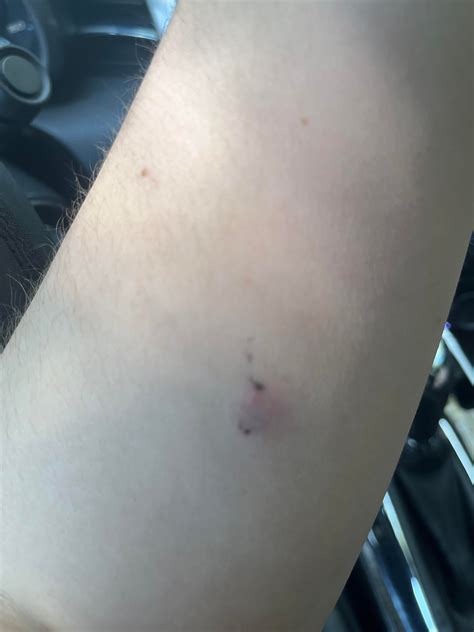 Does This Look Like A Positive Ppd Test Rtuberculosis