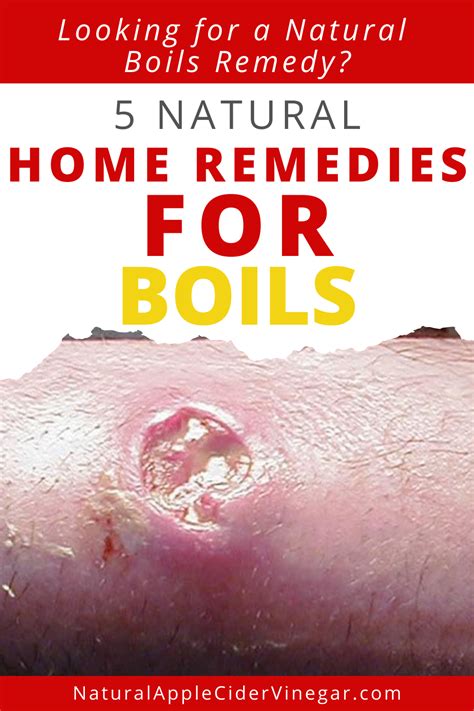 How To Treat A Boil Under Nose At Patricia Bartholomew Blog