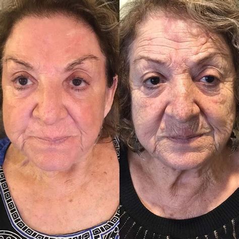 All About Phenol Peel Is It Worth It Risks And Results Phenol Peel Chemical Skin Peel