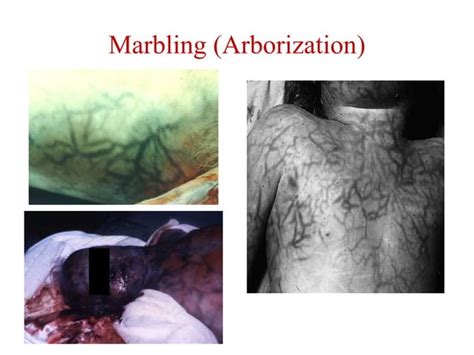 Post Mortem Interval Pptx First Aid Injuries