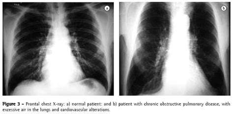 Bronchiolitis Chest X Ray