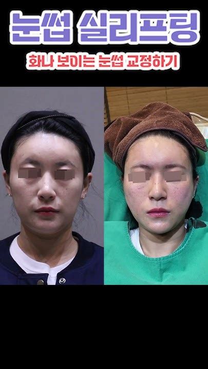 화나보이는 눈썹 모양 교정하기 눈썹 실리프팅실리프팅전후 Shorts Youtube