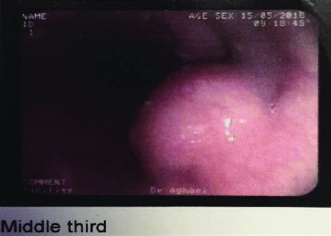 Upper Gastrointestinal Endoscopy In Case 2 Smooth Submucosal Mass In