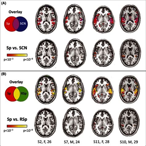 Overlay Maps In Posterior Superior Temporal Cortex Axial Slices Of