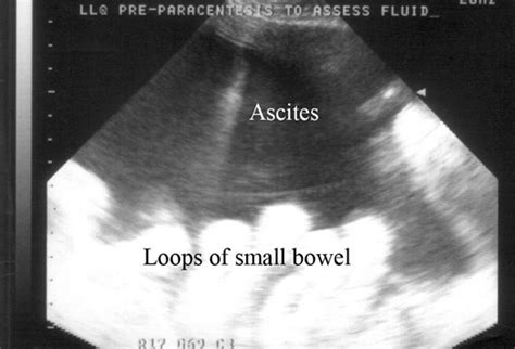 Best Practices Of Paracentesis ~ Medica Chemistry