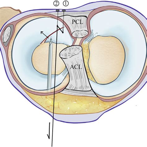 Surgical Anatomy Of Medial Open Wedge High Tibial Osteotomy Crucial