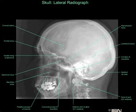 X Ray Skull Lateral View Collection Of Skull X Ray Image Of Human