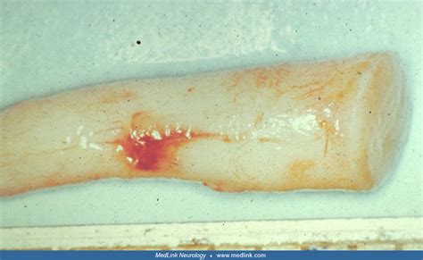 Visual Pathway Gliomas Medlink Neurology