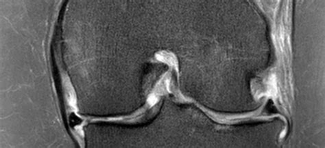 Orthoregen Intraosseous Injections