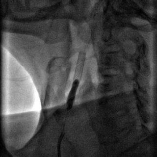 Selective Angiography Confirming Critical Download Scientific Diagram