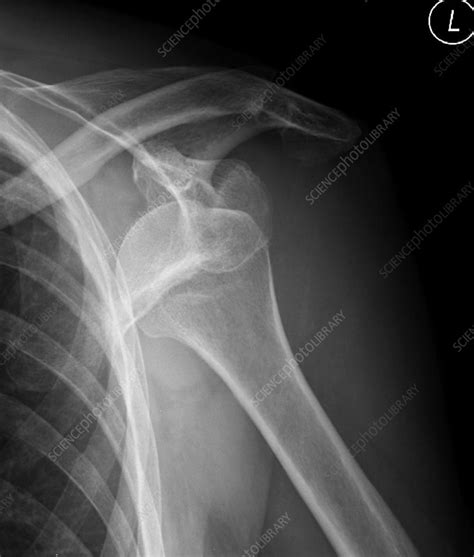 Anterior Glenohumeral Subluxation X Ray Stock Image C0393241