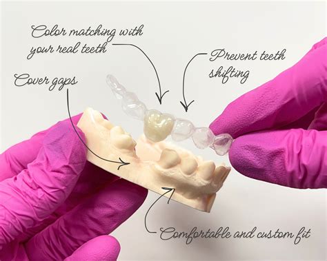 Essix Retainers With A Fake Tooth A Temporary Solution For Patients