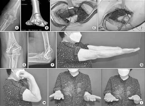 상완골 소두 골절에서의 관혈적 정복 및 내고정술