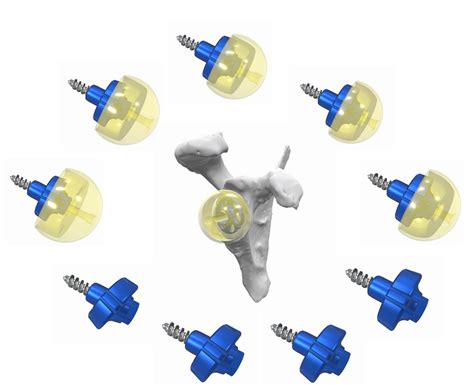 Reverse Shoulder Replacement Shoulder Innovations