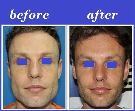 Bangkok Aesthetic Surgery Center Jaw Reduction By Botox Before And