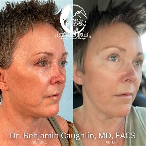 Perioral Mound Treatment Before And After Gallery