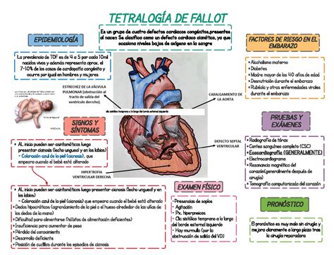 Tarea Cardiomiopatia Congénita TetralogÍa De Fallot Y CaracterÍsticas