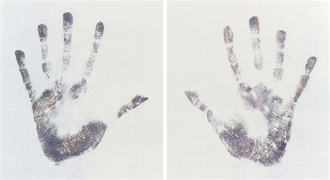 Disorders Of Eccrine And Apocrine Glands Clinical Tree