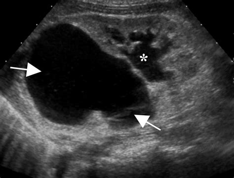 Duplicated Upper Urinary Tract Severe Upper Moiety Hydronephrosis And Download Scientific