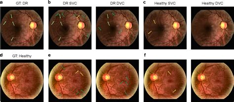 Figure 2 From Generating Realistic Counterfactuals For Retinal Fundus And Oct Images Using