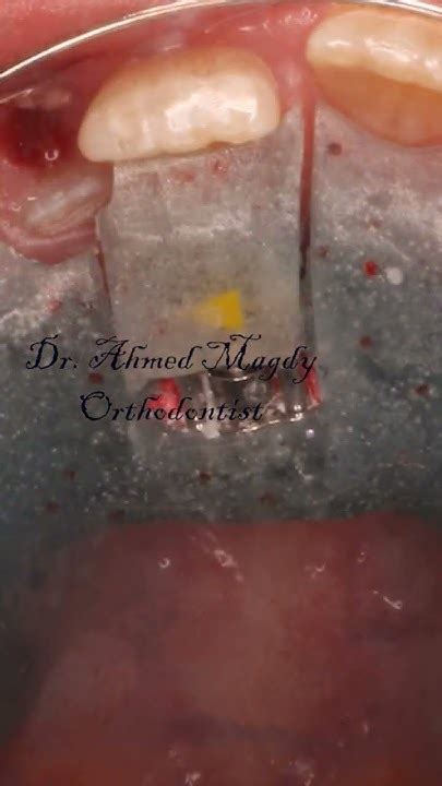 Interceptive Orthodontic Treatment Single Tooth Crossbite Youtube