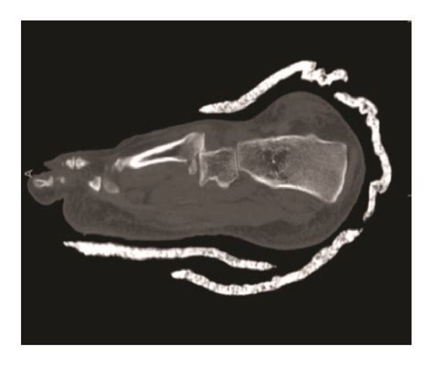 Ct Scan Demonstrating Dislocation Of Fourth And Fifth Tarsometatarsal Download Scientific