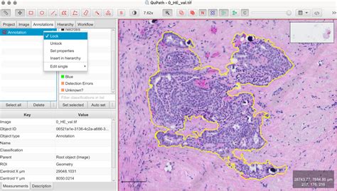 Qupath Cell Counting Cancer Informatics