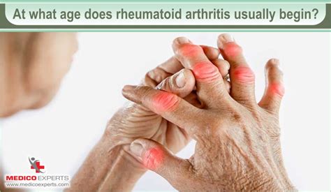 What Are The Non Surgical Treatment Options For Rheumatoid Arthritis
