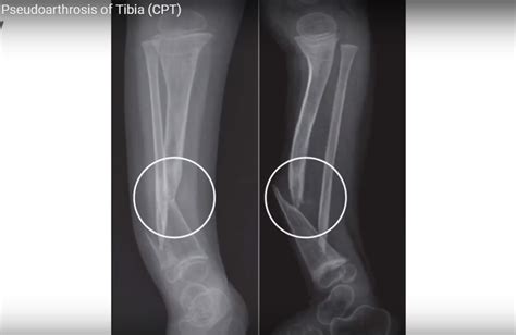 Congenital Pseudoarthrosis Of Tibia —