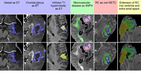 Figure 4 From The 2024 Brain Tumor Segmentation Brats Challenge Glioma Segmentation On Post