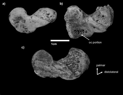 Variable Morphology Of Scaphoid Centrale Fusion And Nonfusion In