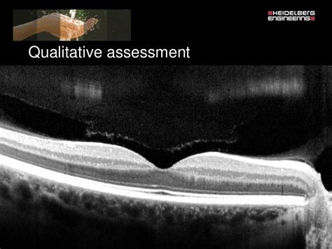 Spectralis Oct Normal Anatomy And Systematic Interpretation