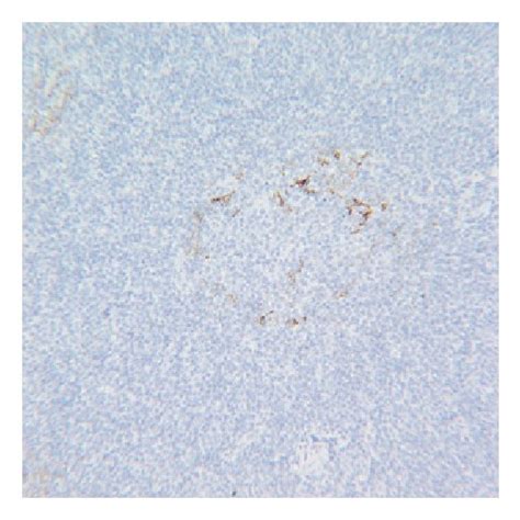 Composite A Hande Section Of Lymph Node Biopsy With An Atypical