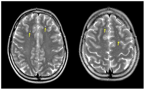 Frontiers Can Aura Migraine Be Elicited By Isolated Pulmonary