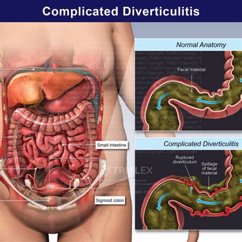 Medical Legal Exhibits Legal Animations And Trial Graphics